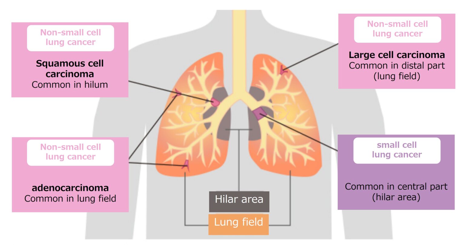 Solid cancer: Therapeutic for Non-Small Cell Lung Cancer | Renascience