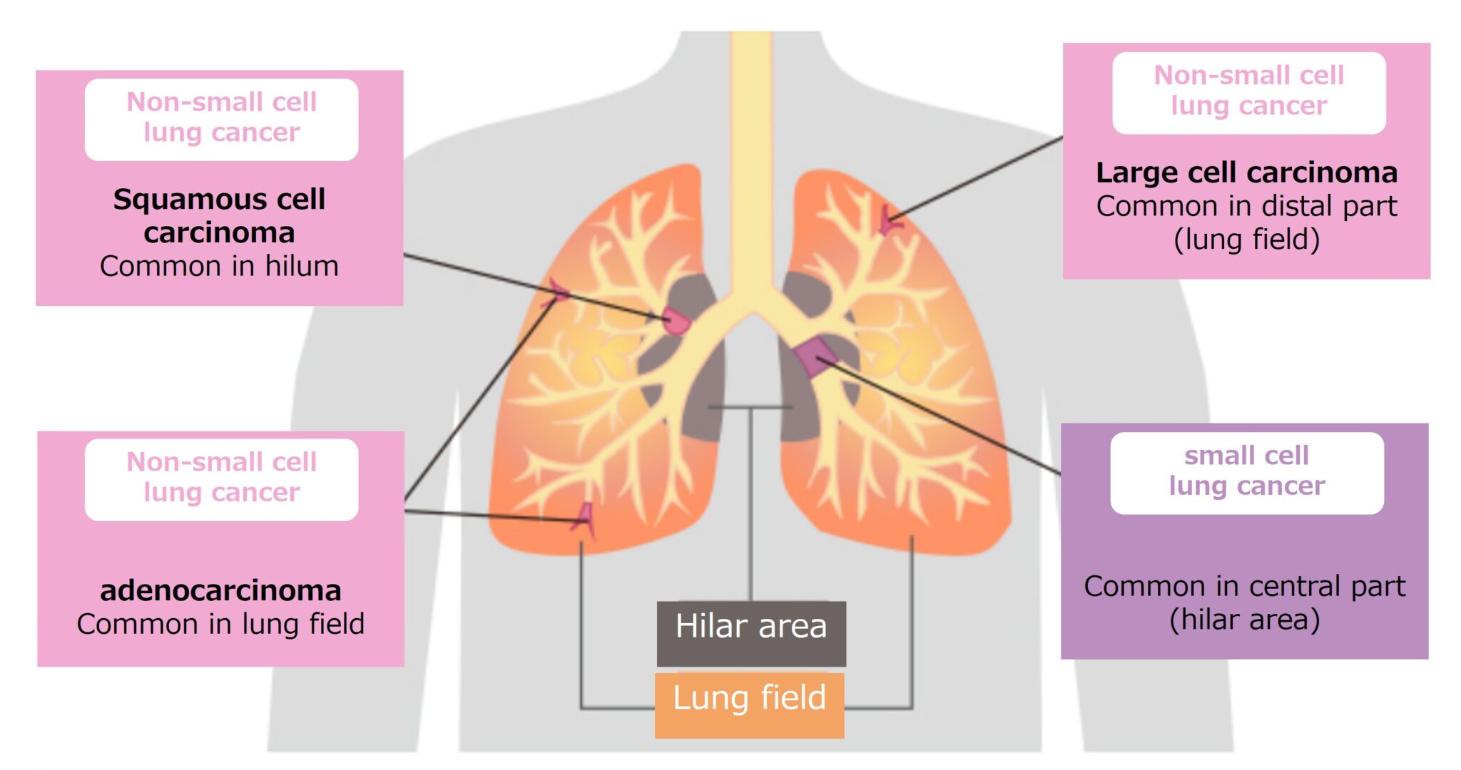 Solid cancer: Therapeutic for Non-Small Cell Lung Cancer | Renascience